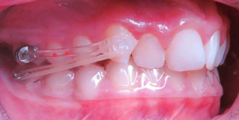 Class 2 Malocclusion with Invisalign® Treatment